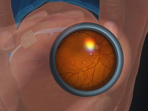 Eyesi Indirect ROP - Standardized curriculum